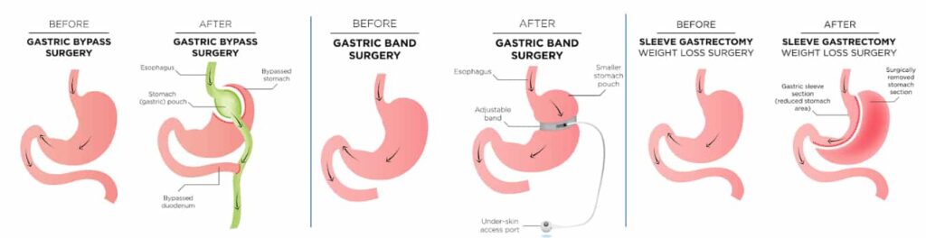 Weight Loss Surgery: Before & After Photos, Gender-Specific Results ...